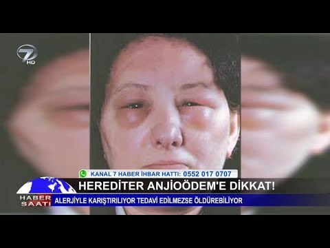 Herediter Anjioödem'e Dikkat!