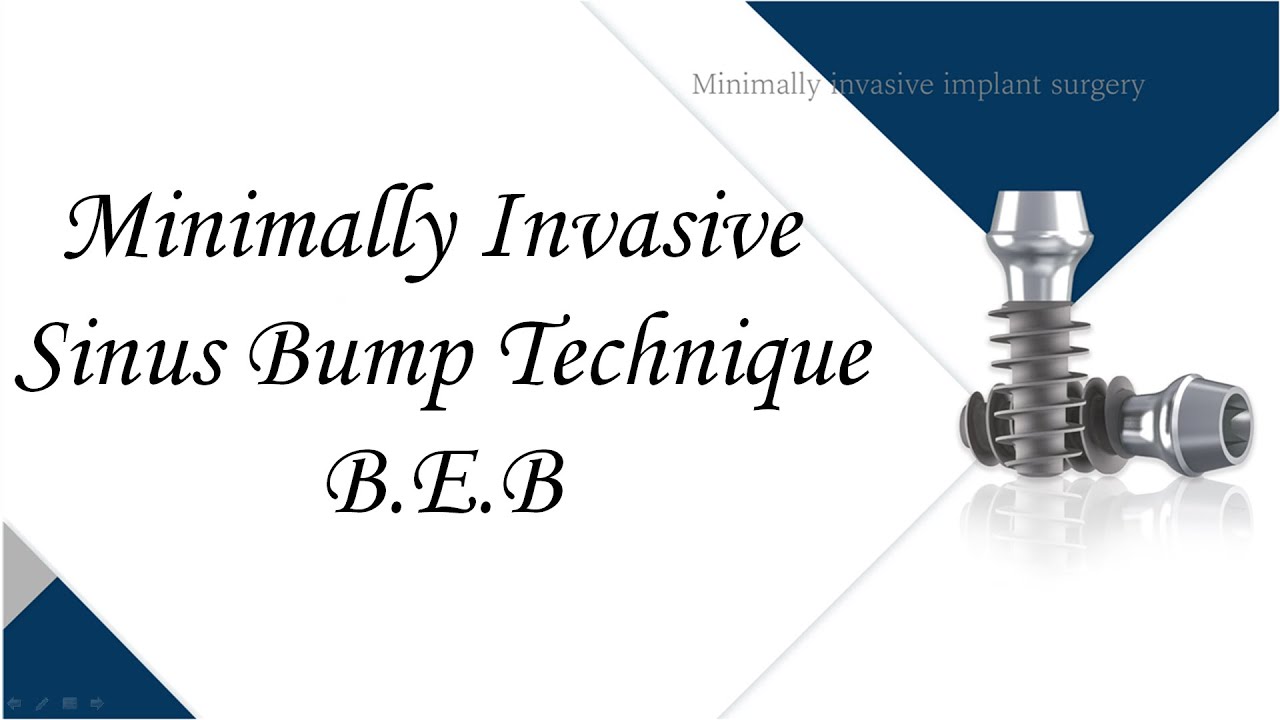 Minimally Invasive Sinus Bump Technique B.E.B. - YouTube