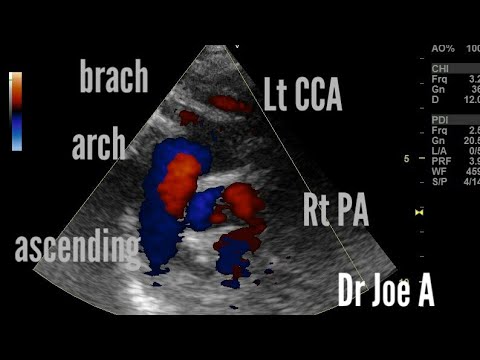 Suprasternal view aortic arch, echocardiography, ultrasound and color ...