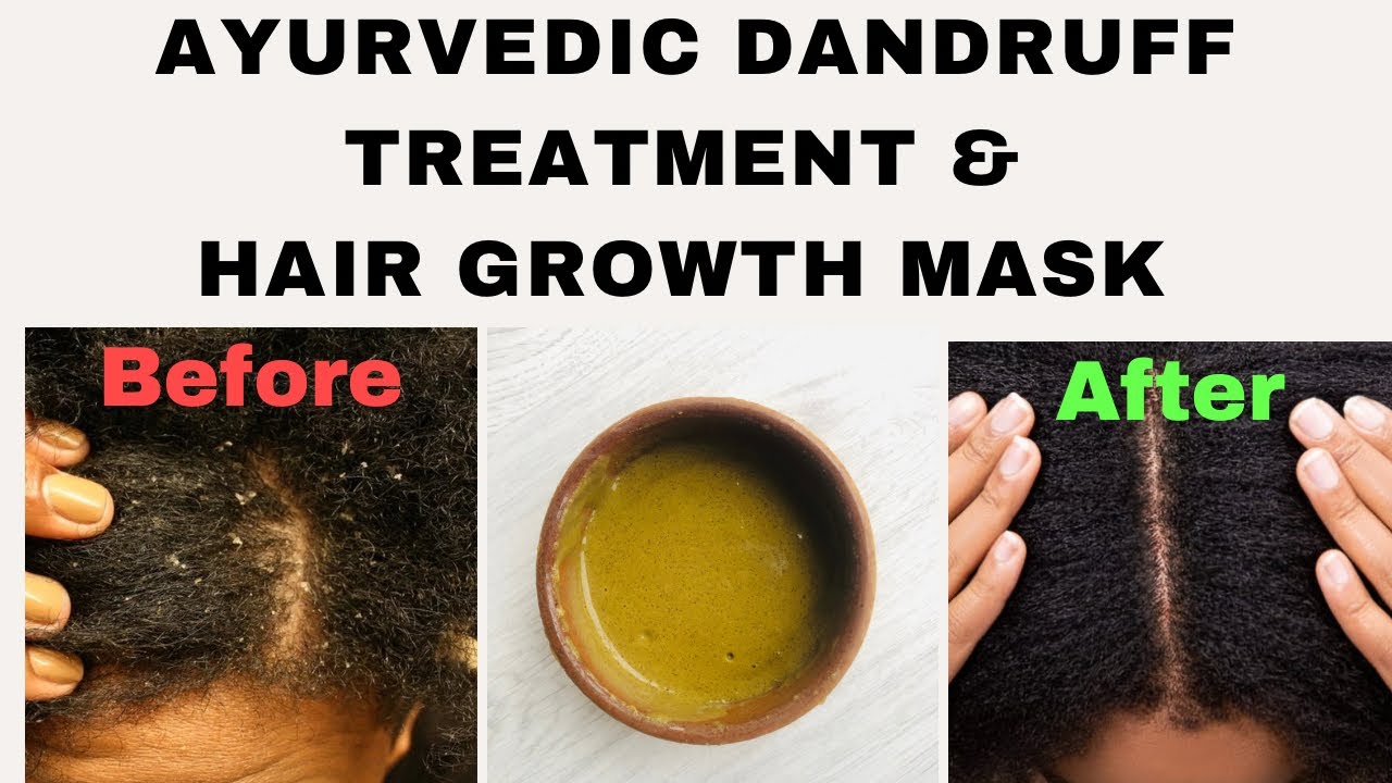 The ULTIMATE Ayurvedic Dandruff Treatment and Hair Growth Mask | Say ...