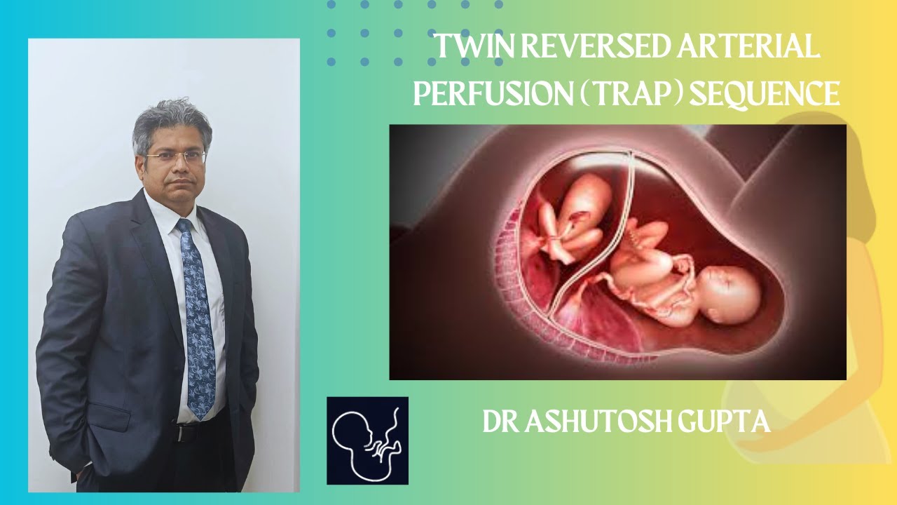 Twin reversed arterial perfusion (TRAP) sequence - YouTube
