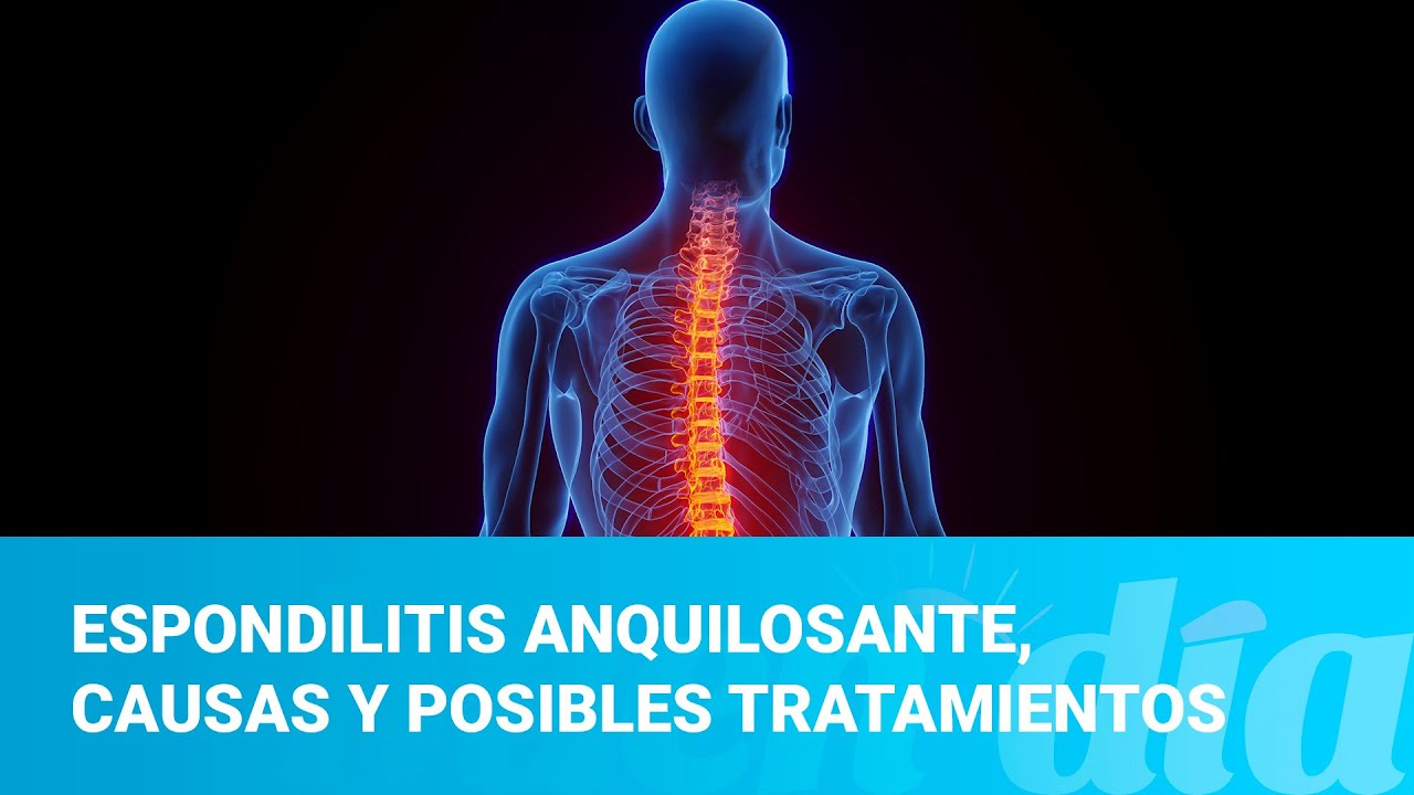 Espondilitis anquilosante, causas y posibles tratamientos - YouTube