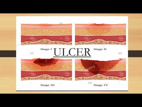 Ulcer explanation, Anatomy and classification | Causes and Symptoms ...