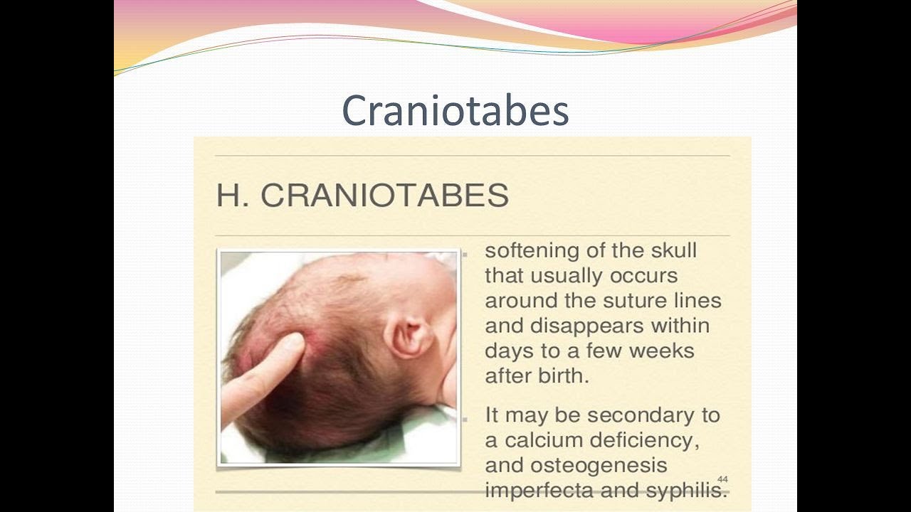 Deformable skull, craniotabes Or softening or thinning of the skull ...