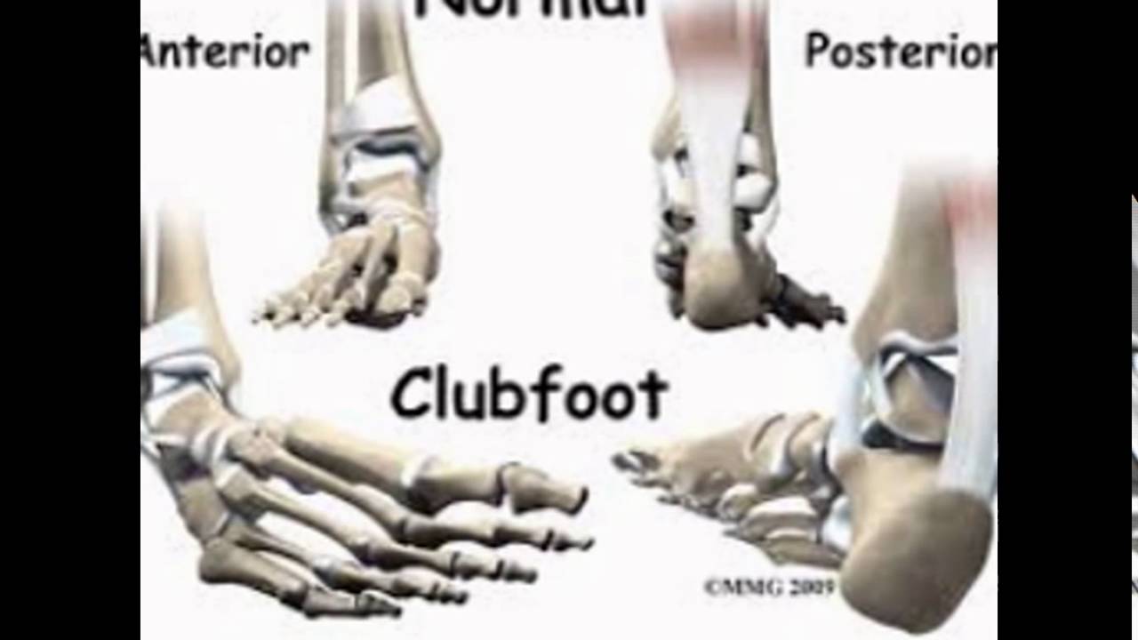 club feet cause|bilateral club feet|clubbed feet in babies|club feet on ...