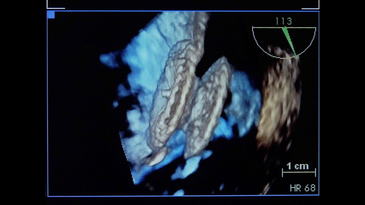 AMPLATZER™ Septal Occluder - YouTube