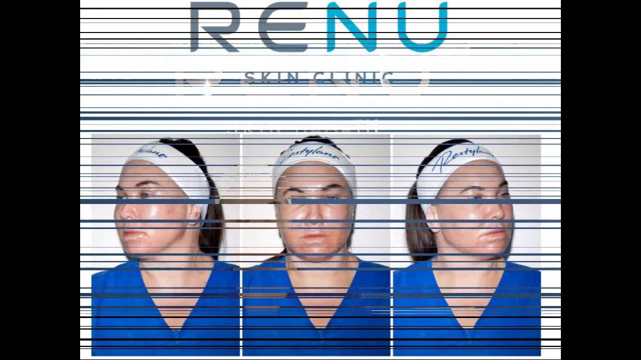 controlled depth peel day 2 - YouTube