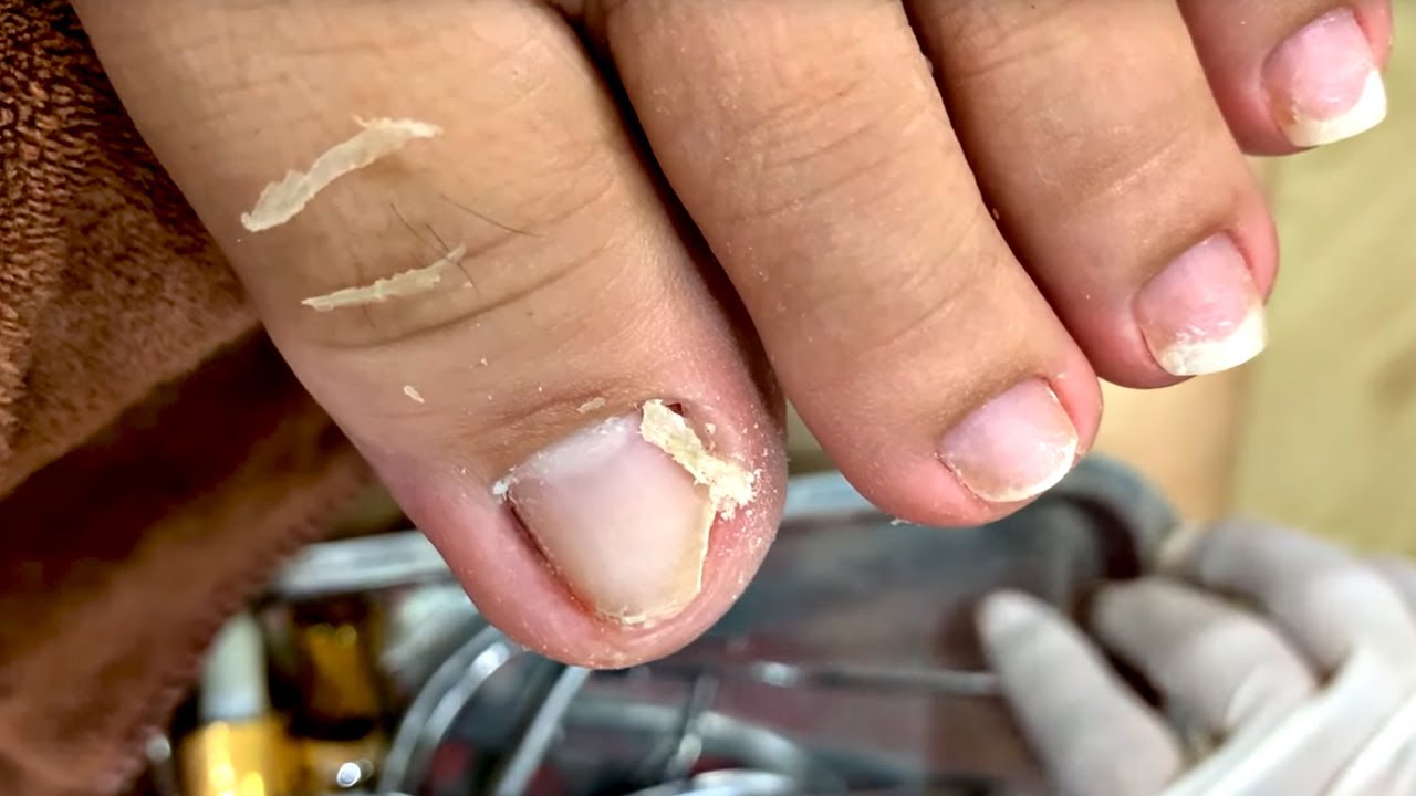 Deep Nail Cleaning Easy #113 - Xuyen Nail - YouTube