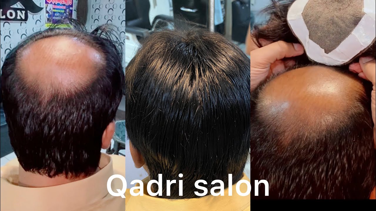 How to patch style on the top head Hair style - YouTube