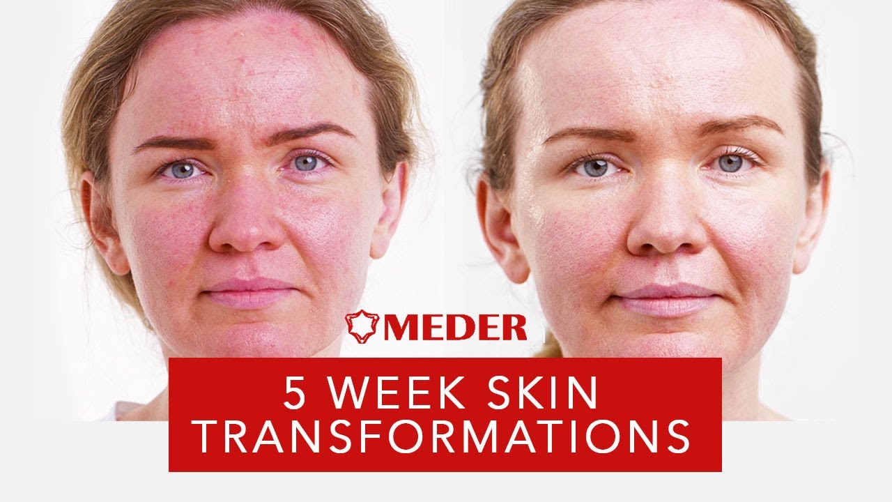 Skin Transformations: Real Skin, Real Results | Before & After - YouTube