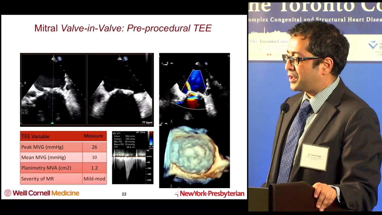 Mitral VIV, Valve in Ring, Valve in MAC - YouTube