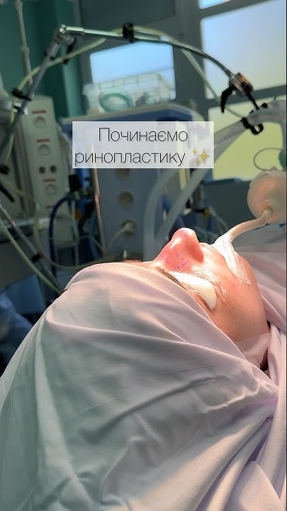 Ніс з горбинкою ринопластика без розрізів на шкірі денищук ніс