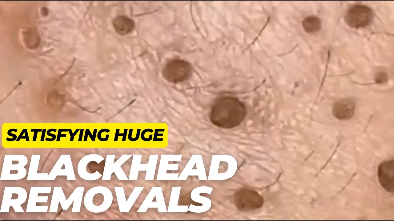 Insane Satisfying Huge Blackheads and Whiteheads Removal | Ultimate ...
