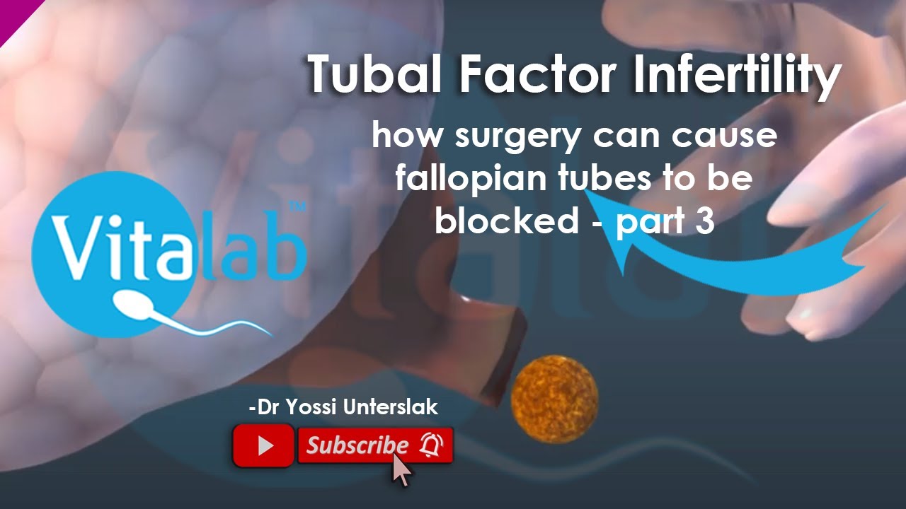 Tubal Factor Infertility- how surgery can cause fallopian tubes to be ...