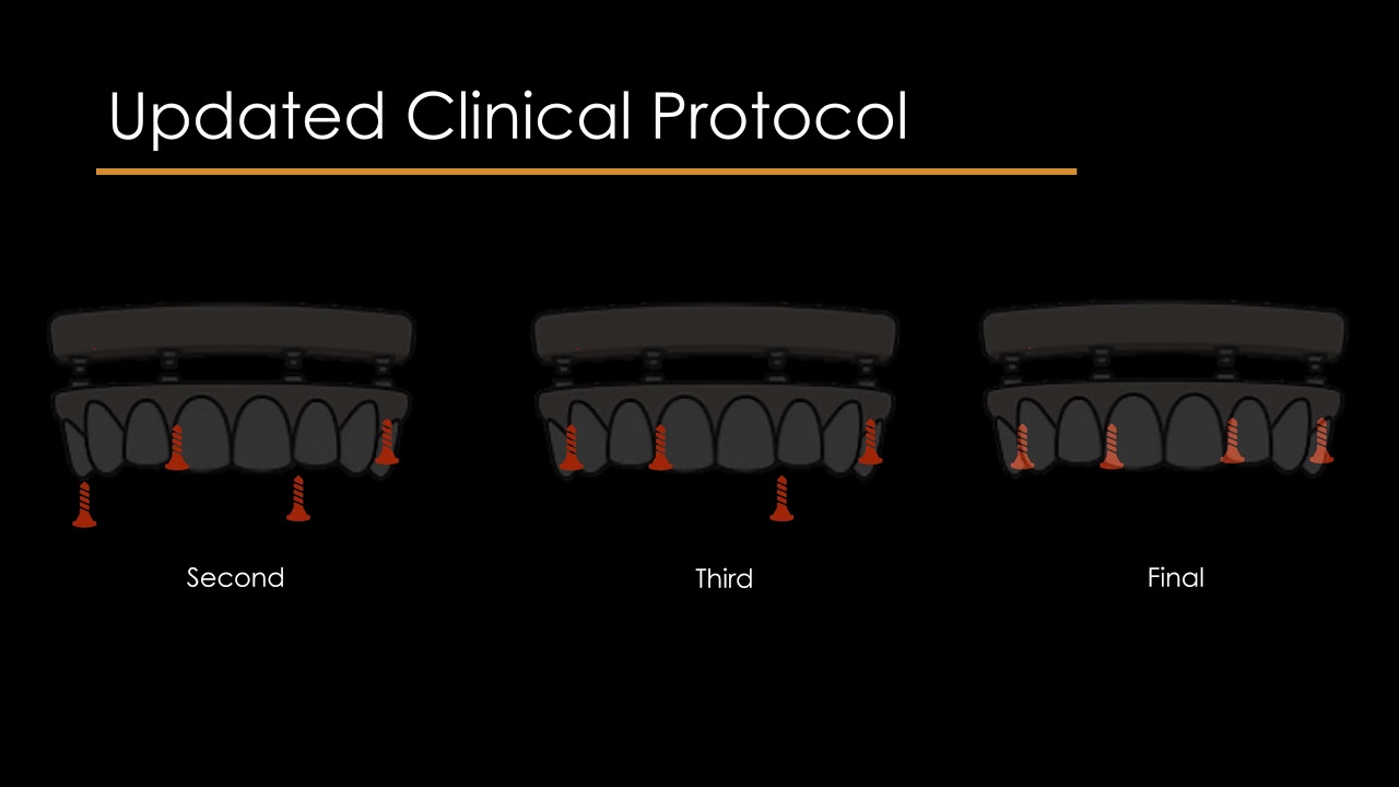 Dentistry Updates - Passive Fit Of Multiple Implant Supported ...