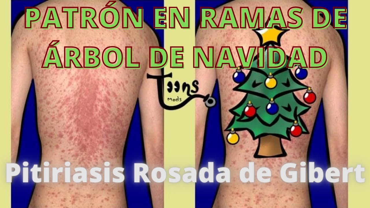 PATRÓN EN RAMAS DE ÁRBOL DE NAVIDAD-Pitiriasis Rosada de Gibert ...