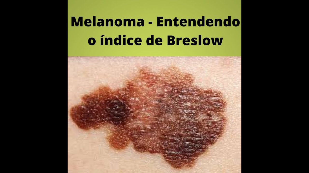 Melanoma - Entendendo o índice de Breslow - YouTube