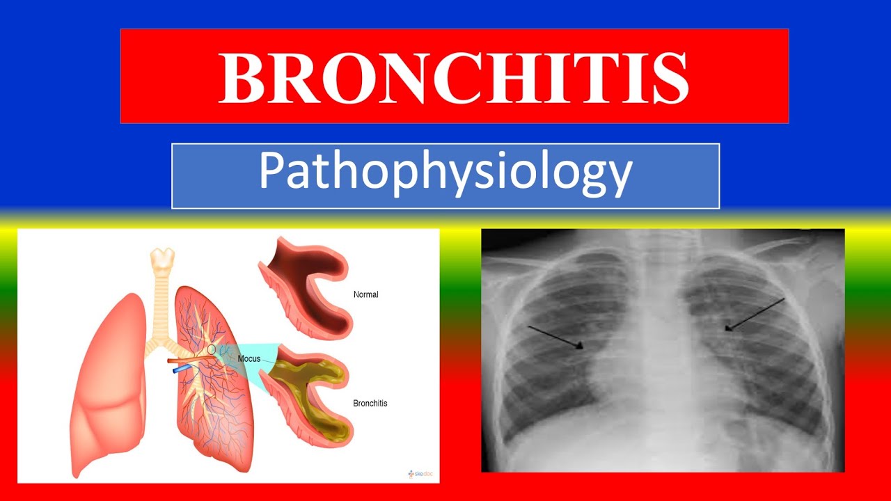 BRONCHITIS -Pathophysiology – Step-by-Step Process Explained - YouTube