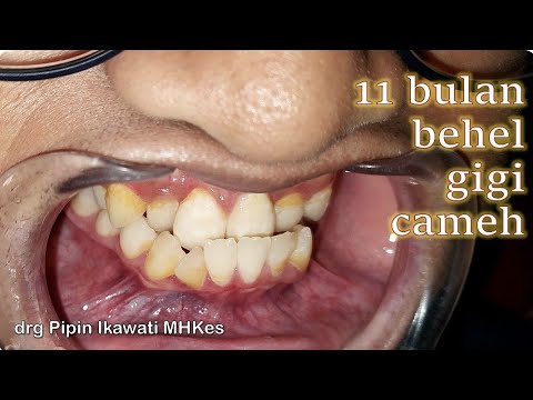11 bulan perawatan behel gigi cameh behel gigi cakil, behel gigi ...