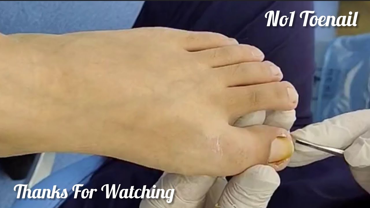 Fix Broken Toe nail 👣 - YouTube