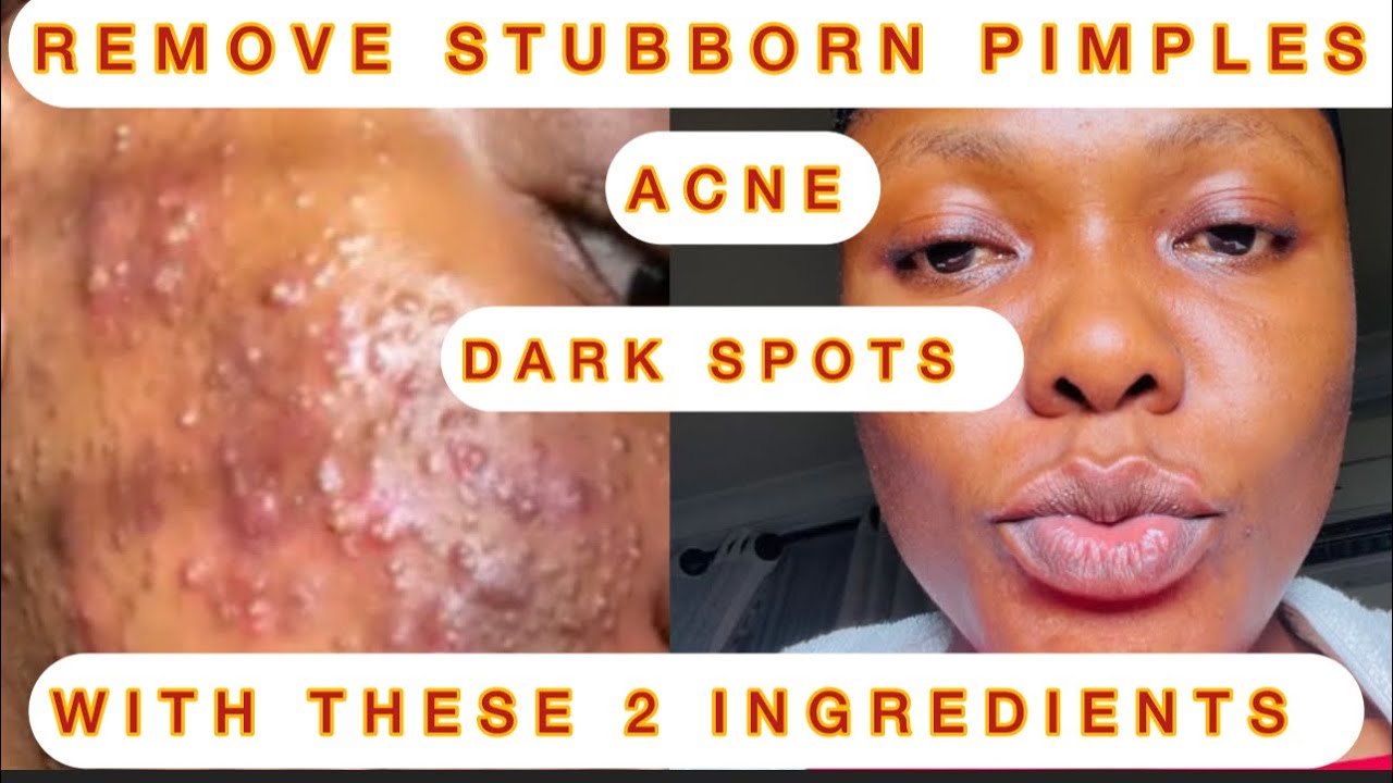 How To REMOVE Stubborn Pimples | Dark Spots | Acne Faster! With 2 ...