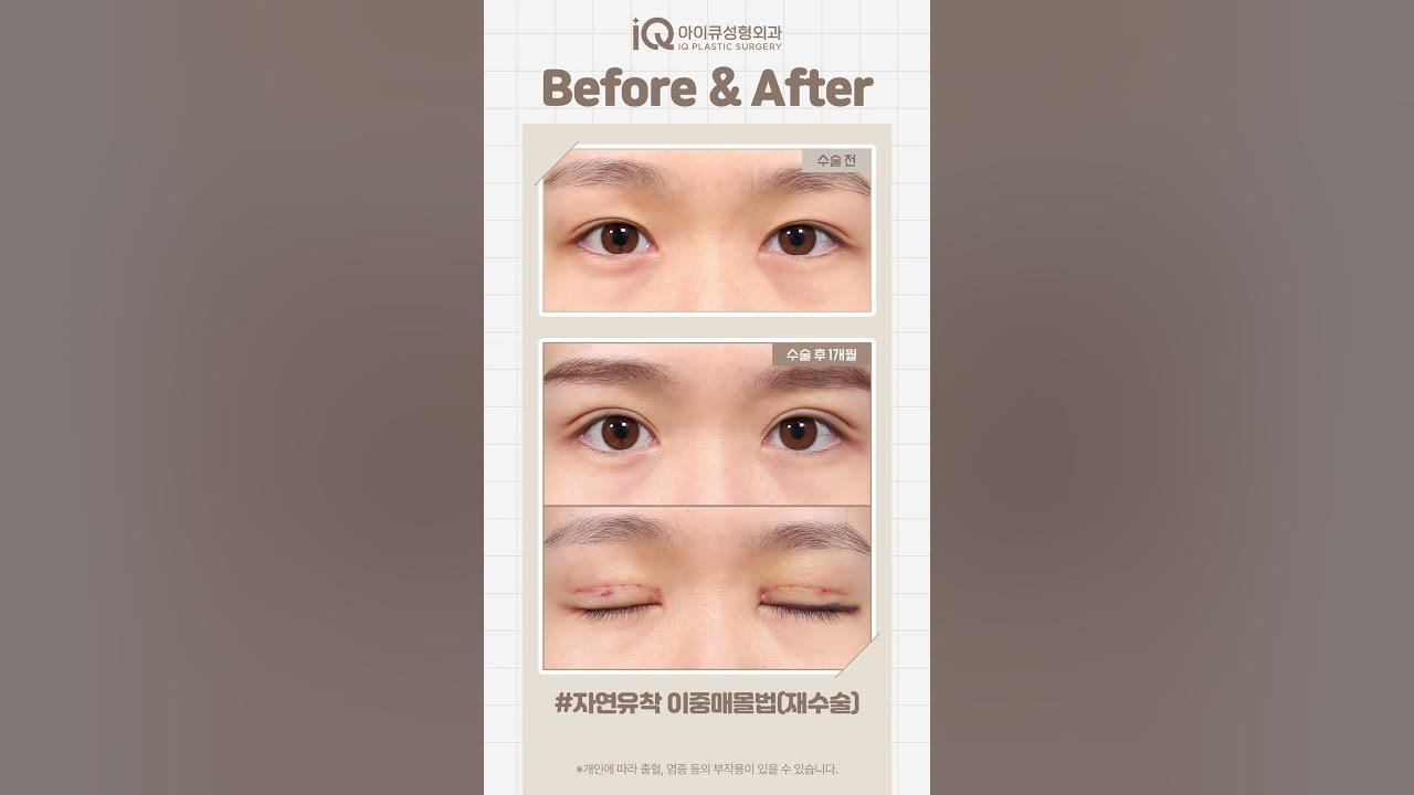 쌍꺼풀 라인 높이기 재수술 자연유착 매몰법 Youtube