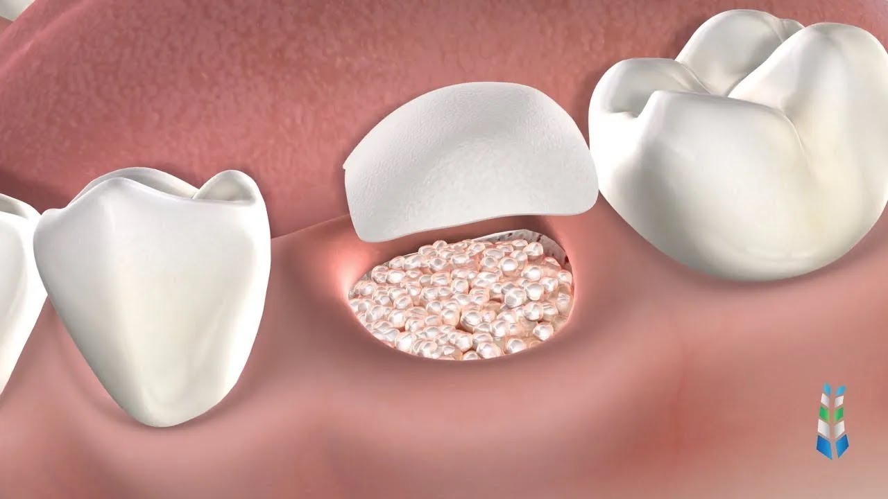 Bone Grafting & PRF in Springfield IL at Oral & Facial Surgeons of ...