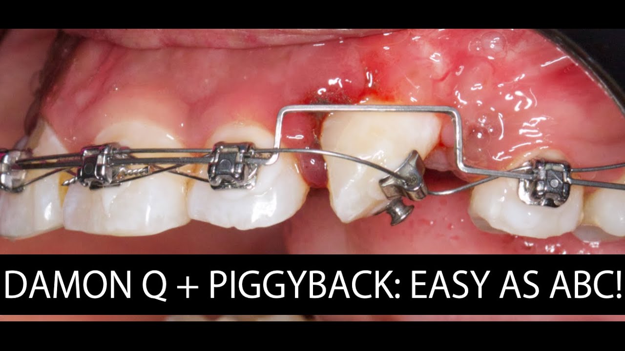 DAMON BRACKETS + PIGGYBACK YT: MAGIC! - YouTube