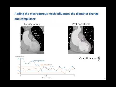 Biomechanical evaluation of personalized external aortic root support ...
