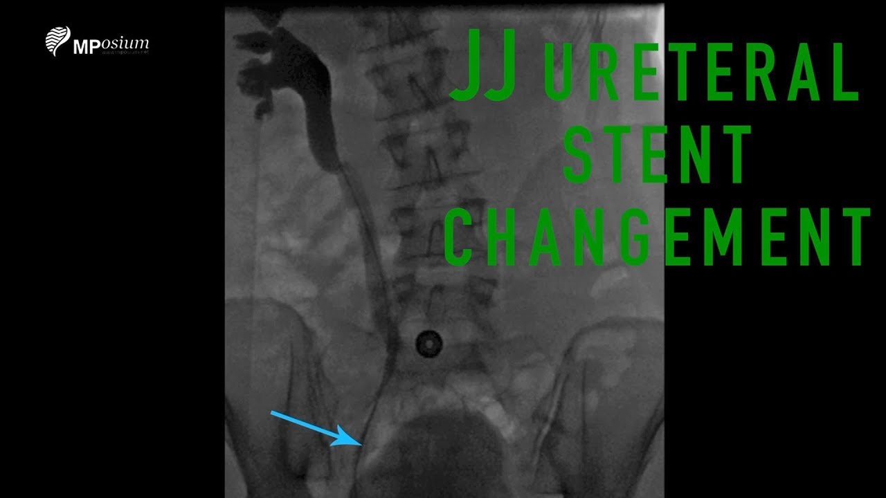 JJ ureteral stent changement - YouTube