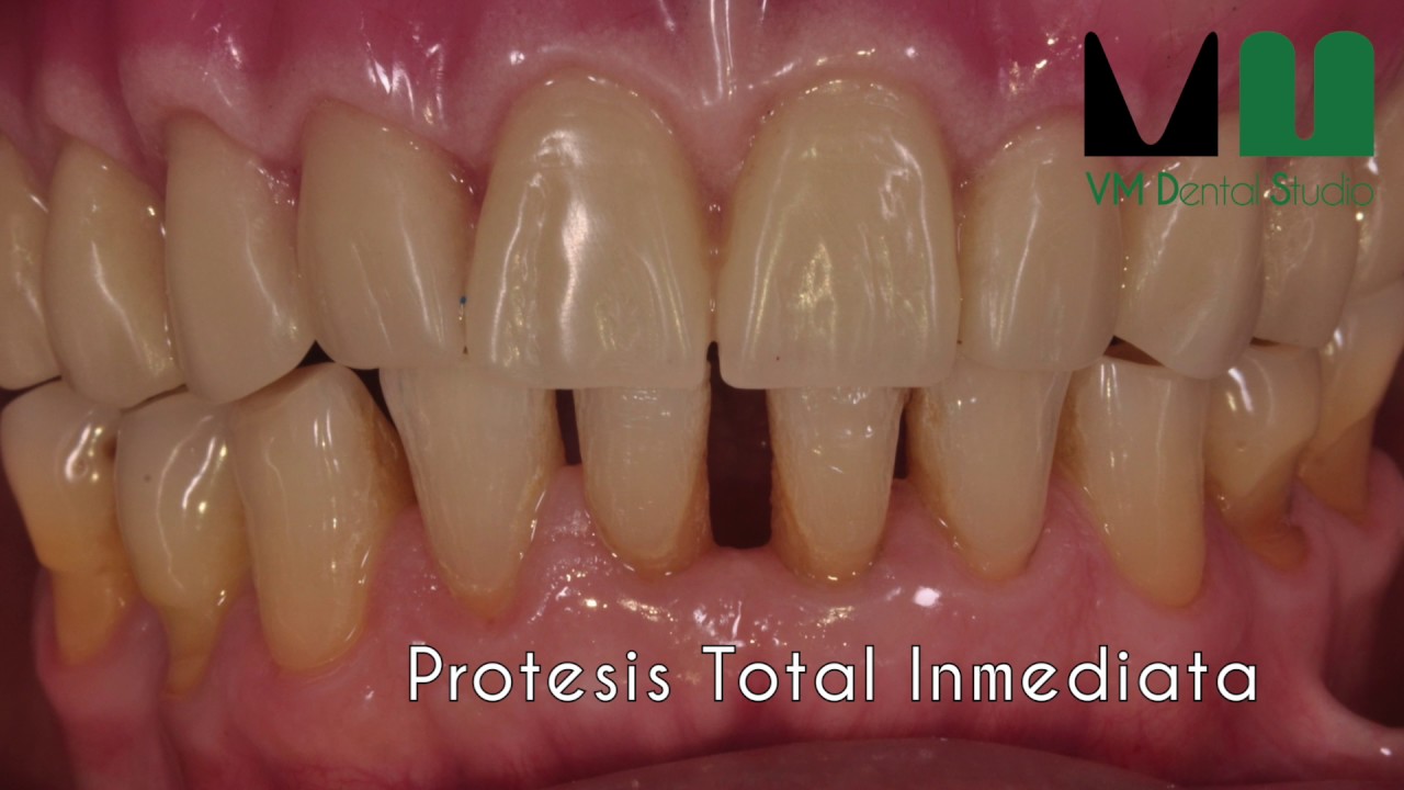 Prótesis Inmediata - YouTube