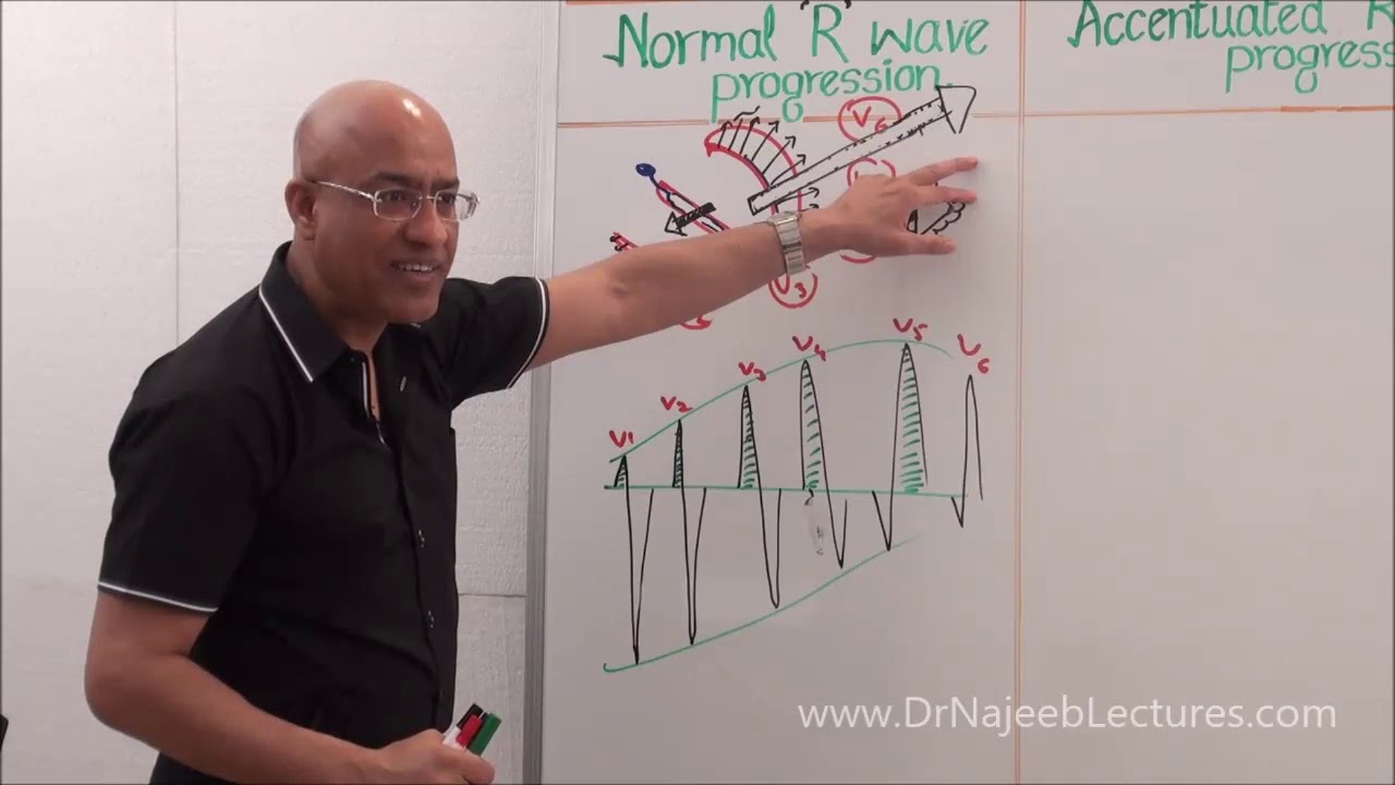 Mastering Chest Leads Abnormalities of R wave progression Members - YouTube