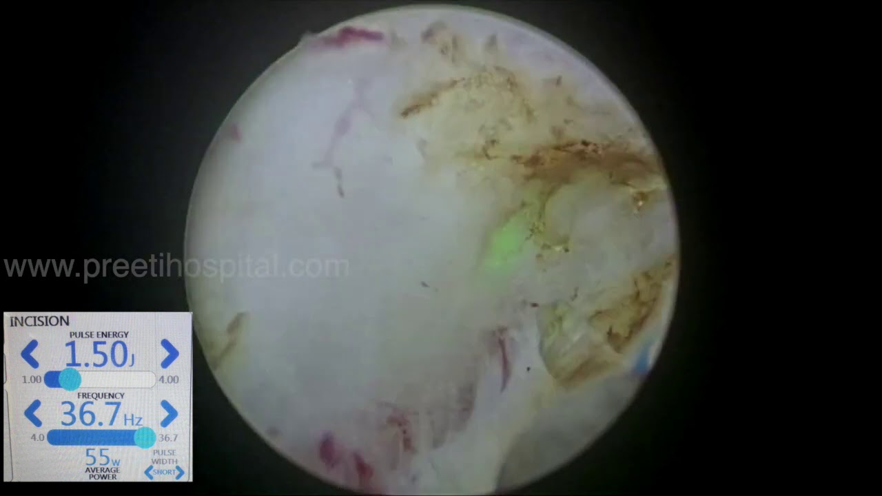 Trilobar Enucleation of Prostate,60 gm prostate large median lobe using ...