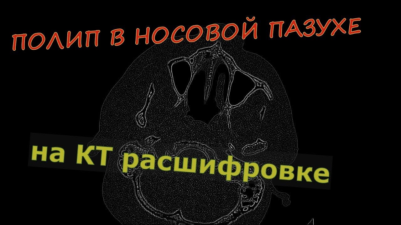 ПОЛИПЫ В ПАЗУХАХ НОСА на КТ расшифровке снимков DICOM с диска - YouTube