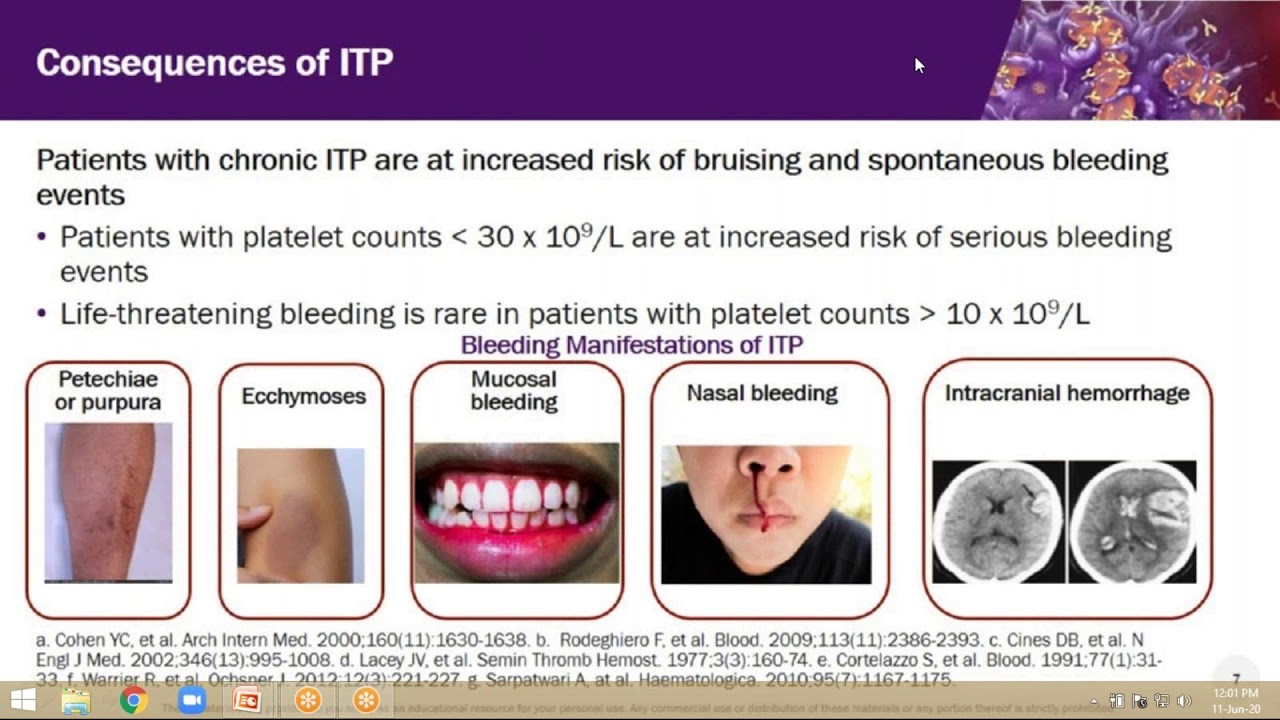 Immune Thrombocytopenia Itp Blood Disorders Msd