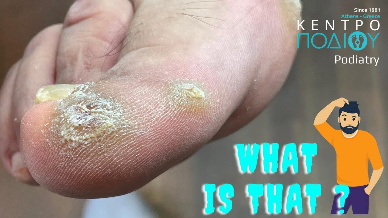 Callus Removal from the dorsal area||Κέντρο Ποδιού Podiaty|Podiatrist ...