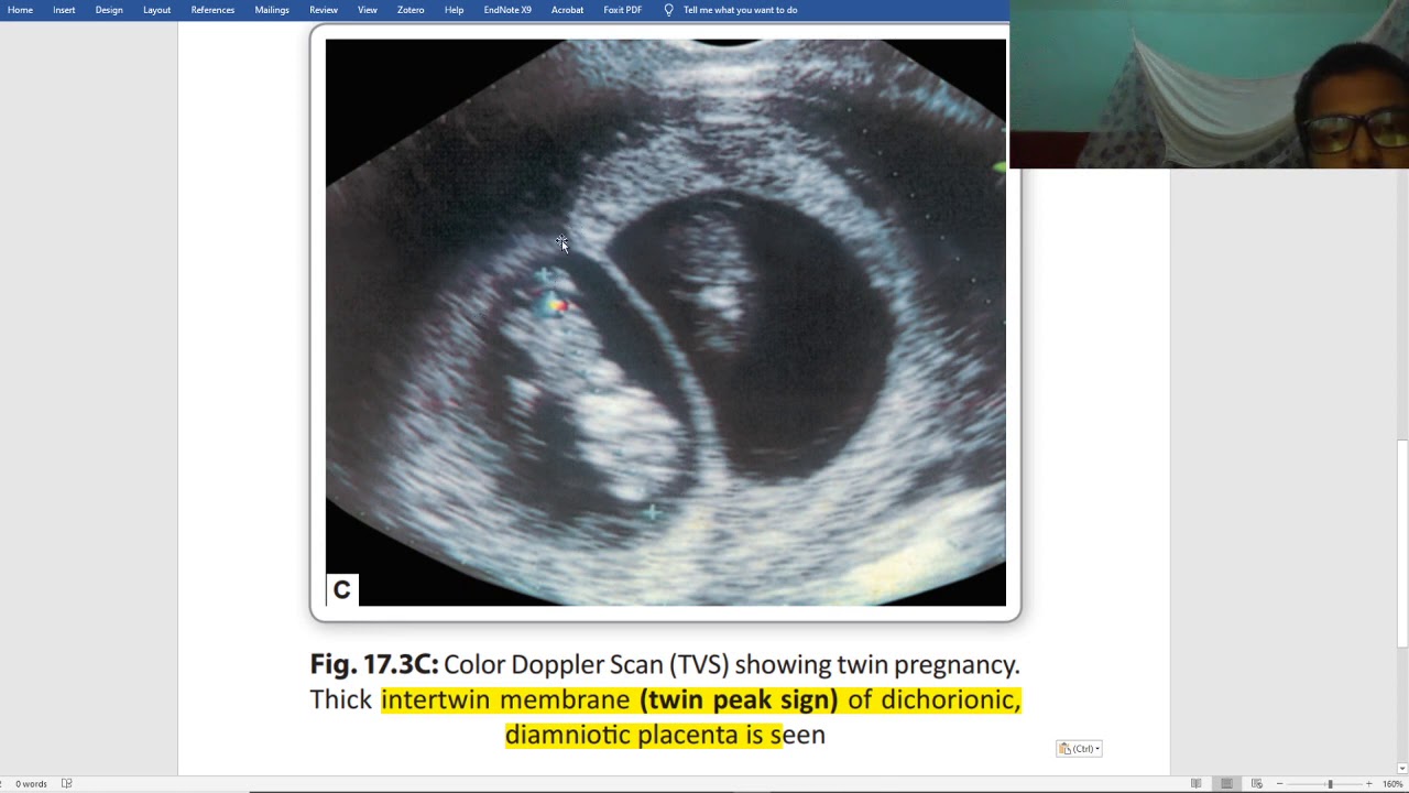 twin peak sign in twin pregnancy - YouTube