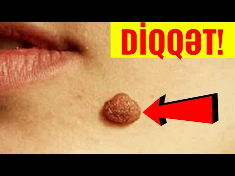 Xallar Hansı Xəstəliyin Əlamətidir? - Xərçəng Yaradır?