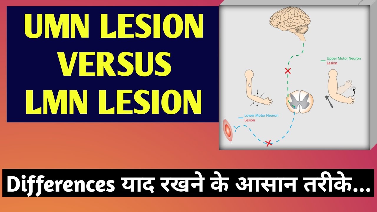 UMN LESION VERSUS LMN LESION| 2023| UMN AND LMN LESIONS IN HINDI, # ...