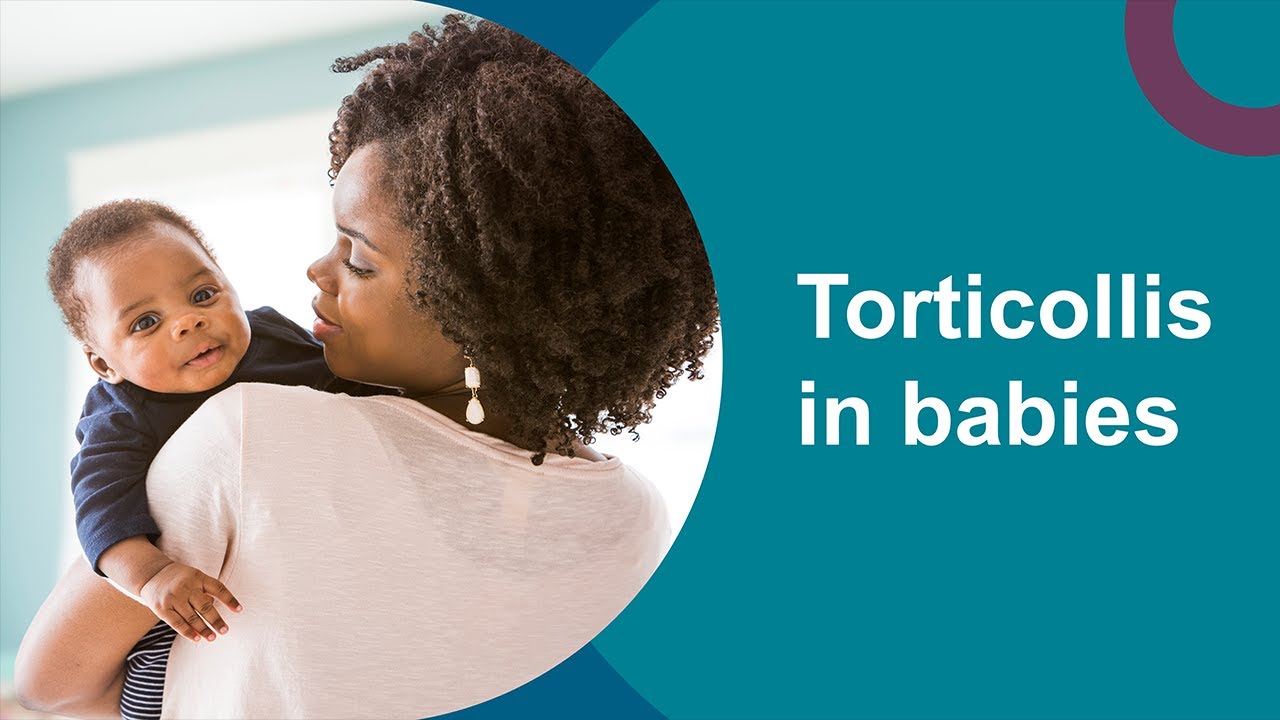 Torticollis in babies: Neck movement and head shape - YouTube