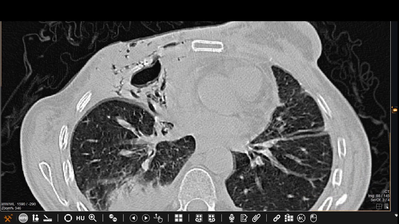 Bronchopleural Fistula - YouTube