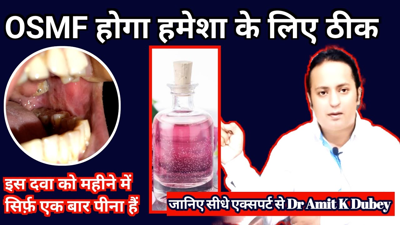 OSMF होगा बिल्कुल ठीक। OSMF treatment in India in Homiopathy। submucous ...