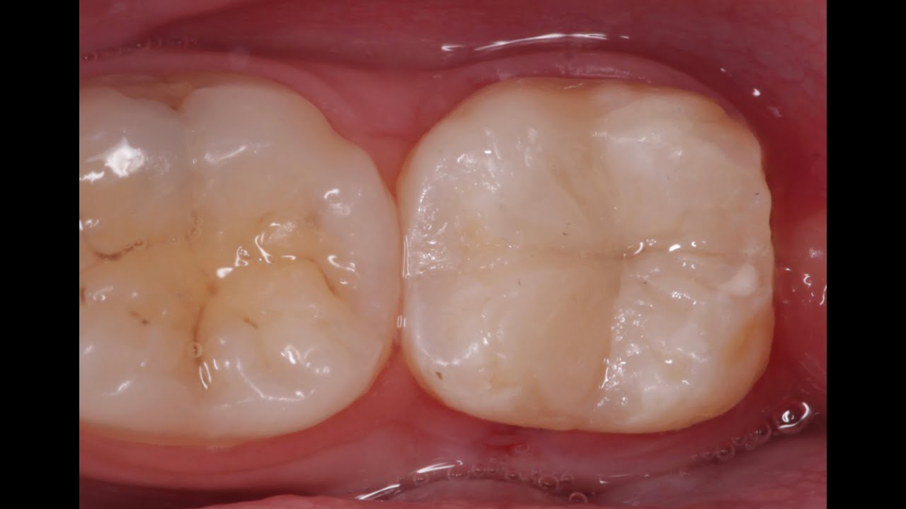 Endo and Direct Composite Restoration - YouTube