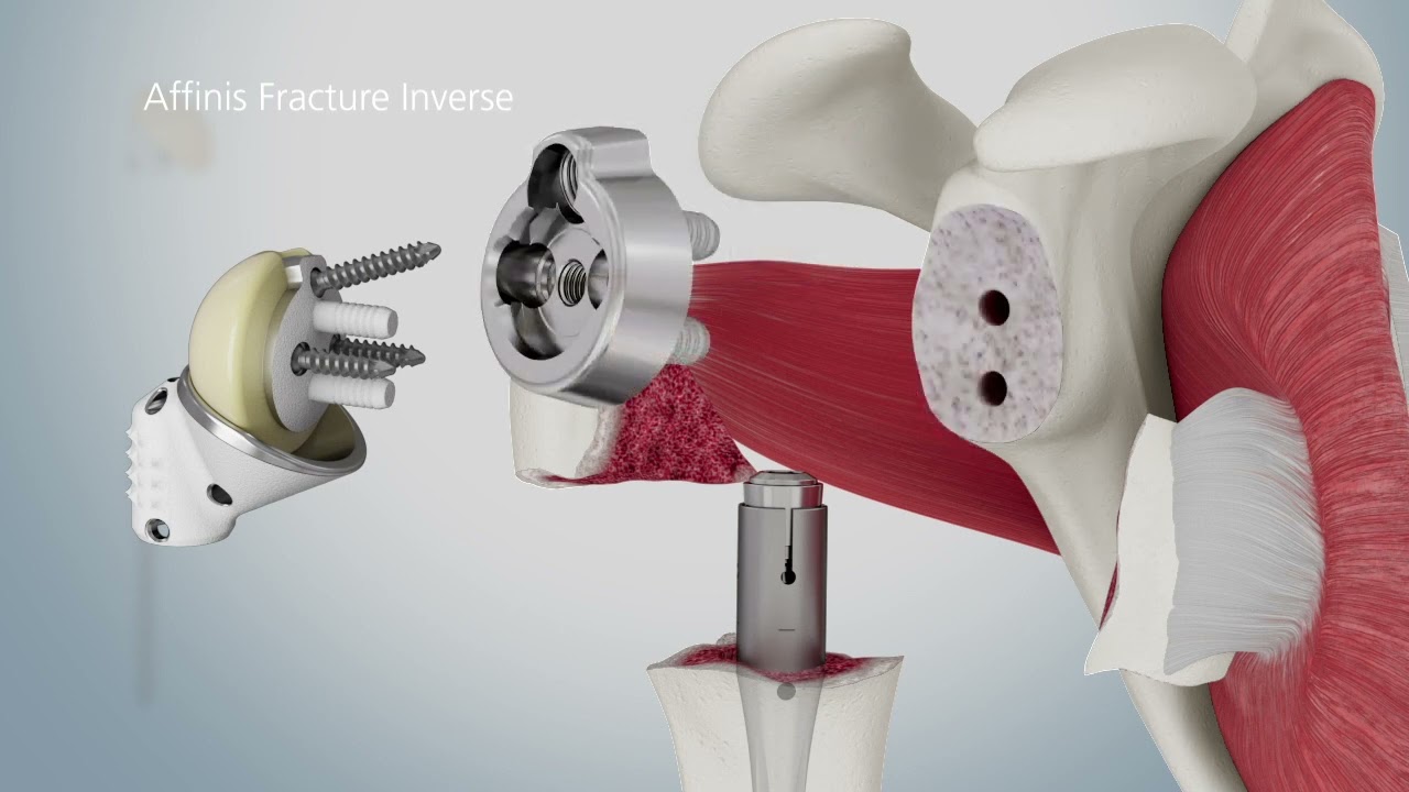 Mathys: Implantation of an Affinis Fracture and its conversion to an ...