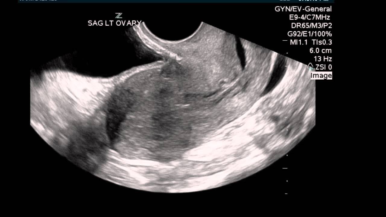 ? myometrial contraction - YouTube