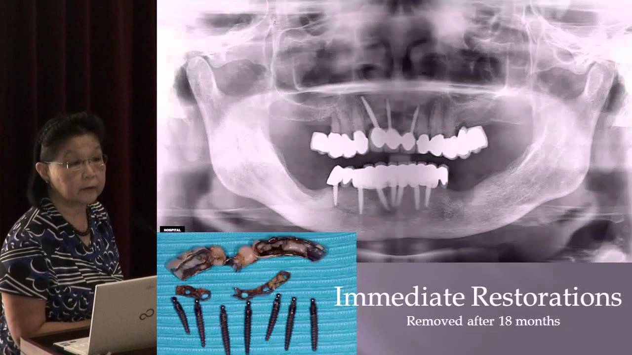 Dental Implants CPG Launch : Narrow Diameter Implants (2 of 2) - YouTube
