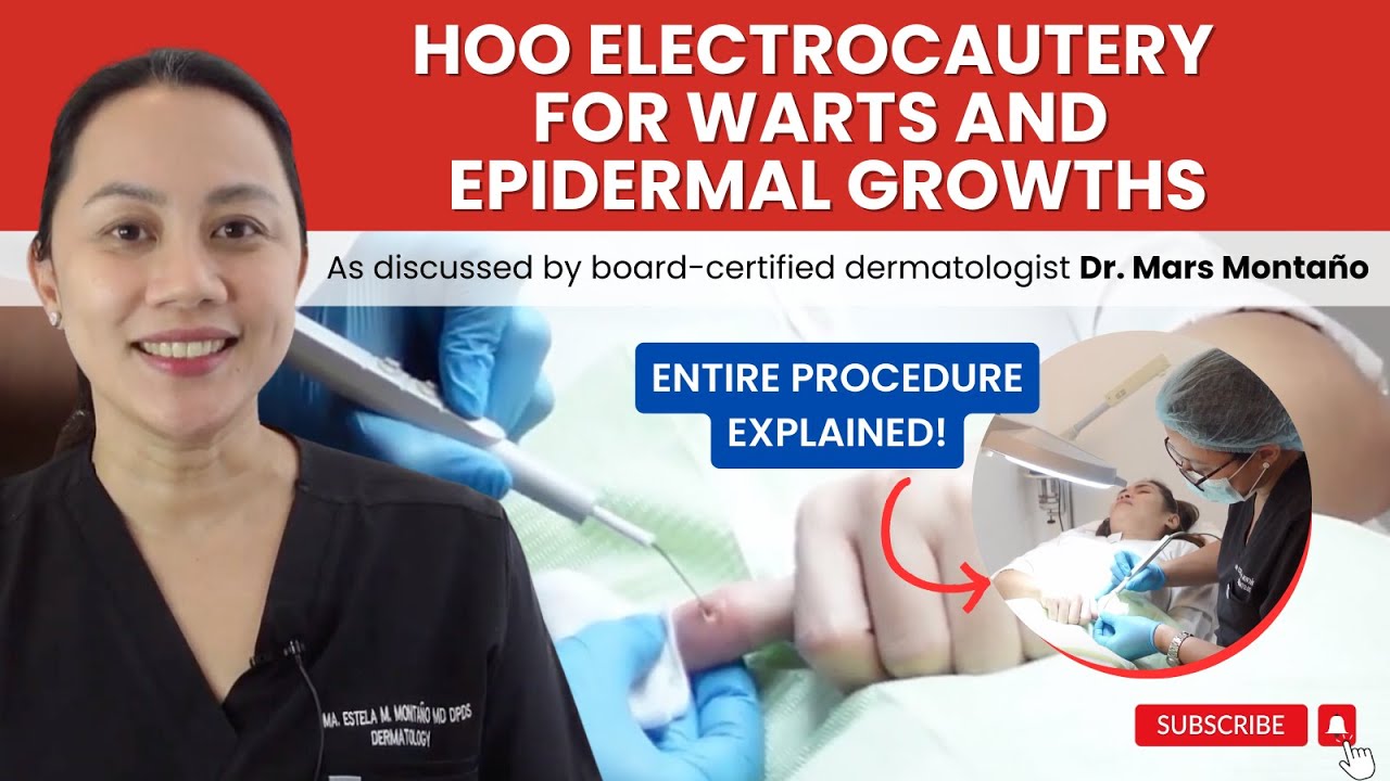 WART REMOVAL WITH ELECTROCAUTERY EXPLAINED - YouTube