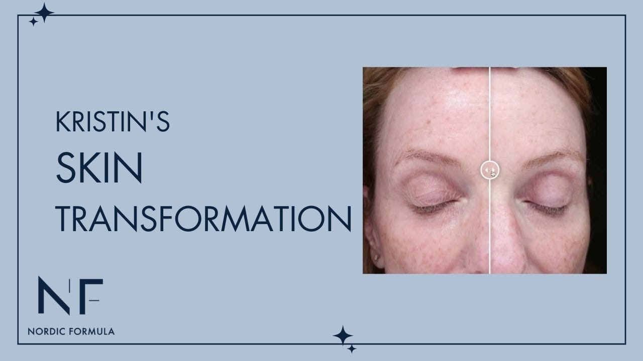 Kristin's Improved Complexion With Nordic Formula - YouTube