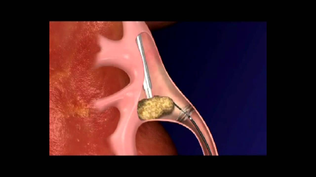 CoAx PCNL Retrograde Animation - YouTube
