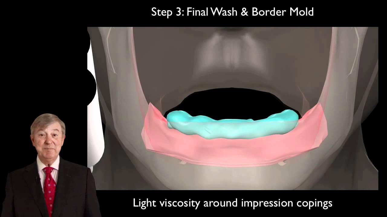 152-00 Treating the Edentulous Arch with Removable Implant Overdentures ...